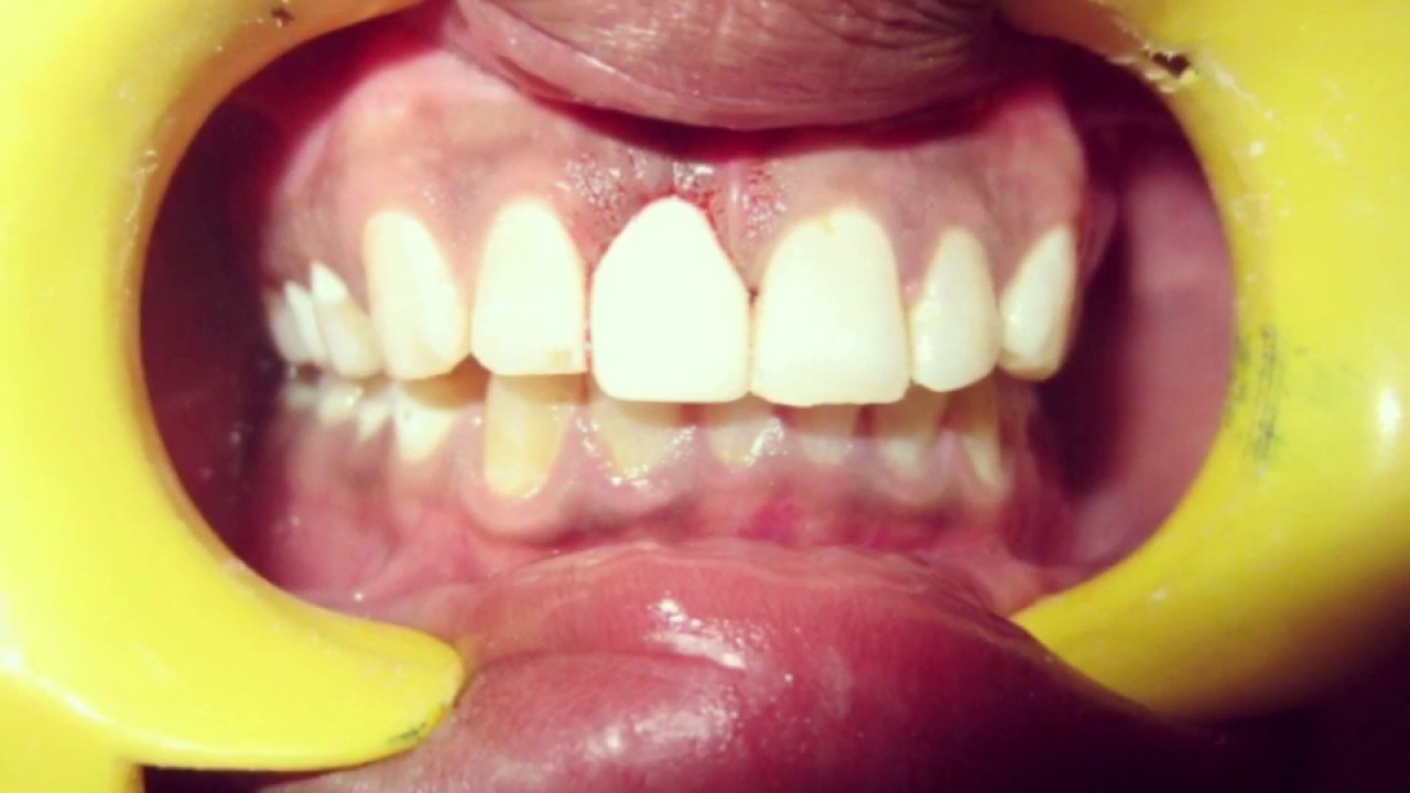 Tooth in an Hour with Dental Implant in Hyderabad, India - YouTube