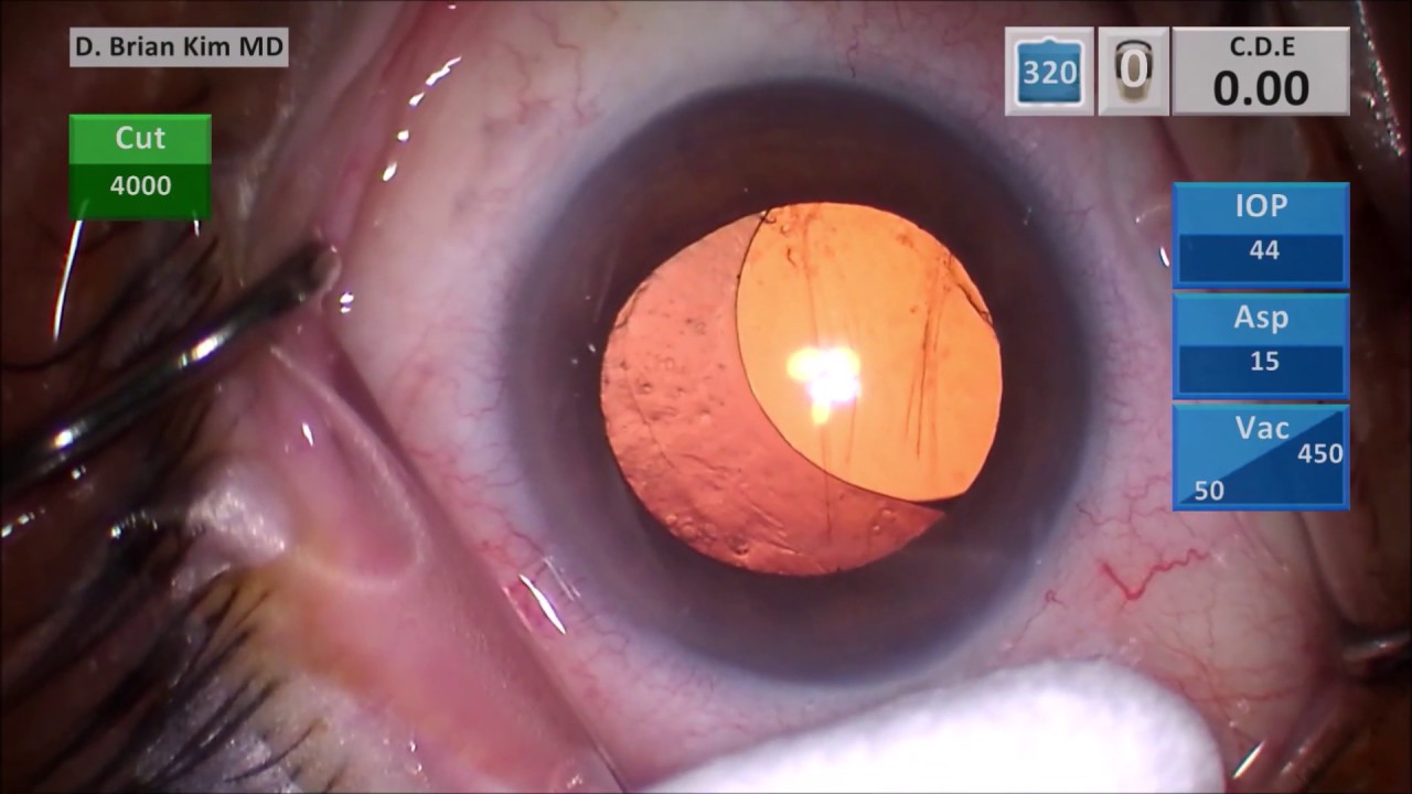 Dislocated IOL: Removal & Exchange, Sulcus IOL, Vitrector Assisted ...