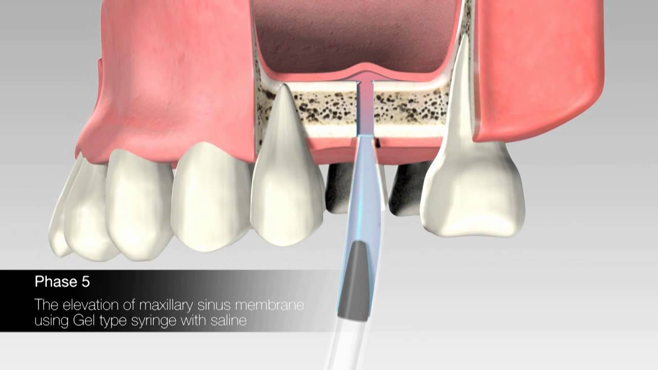 SLD autotome technique - YouTube