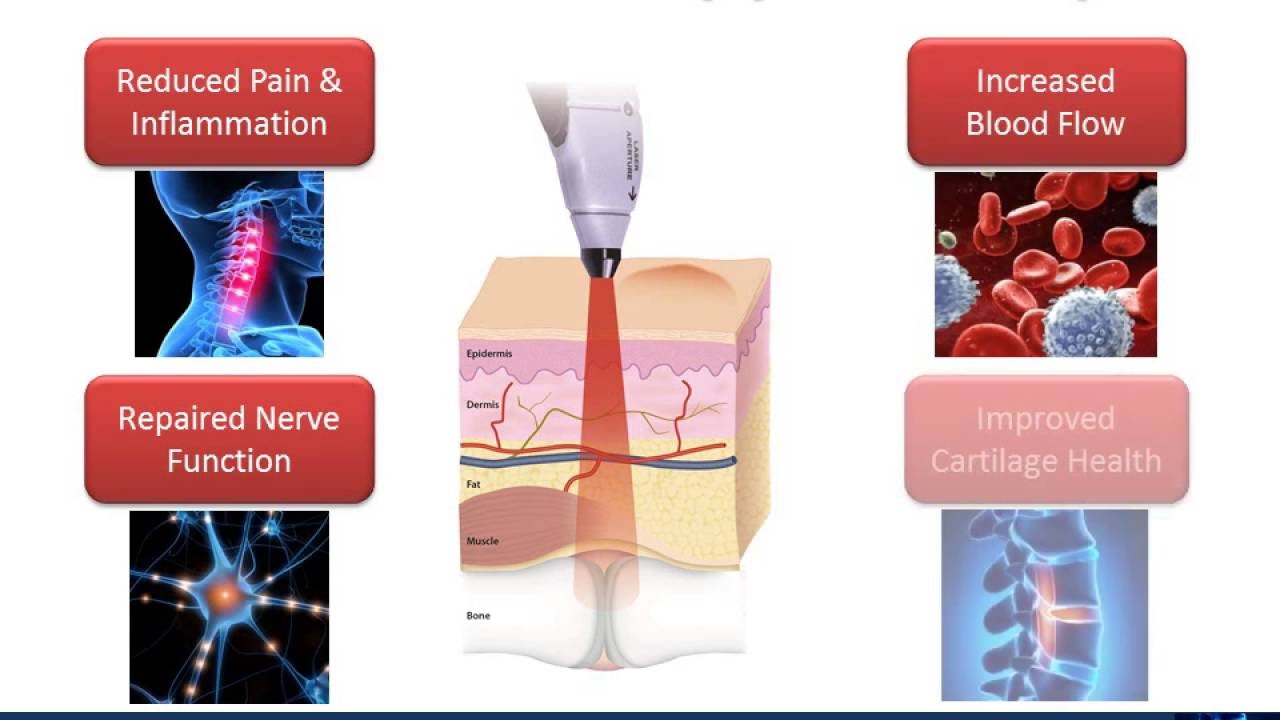 downloads video BioFlex Laser Patient Education Video 2 - YouTube
