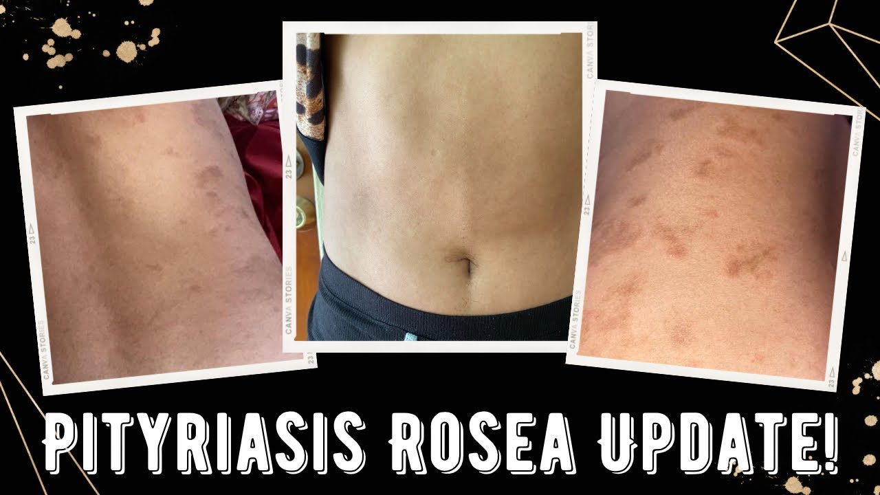 Unbelievable Pityriasis Rosea Update! #pityriasisrosea - YouTube