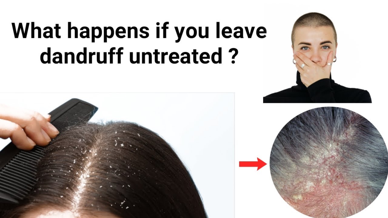 What happens if you leave dandruff untreated ? - YouTube
