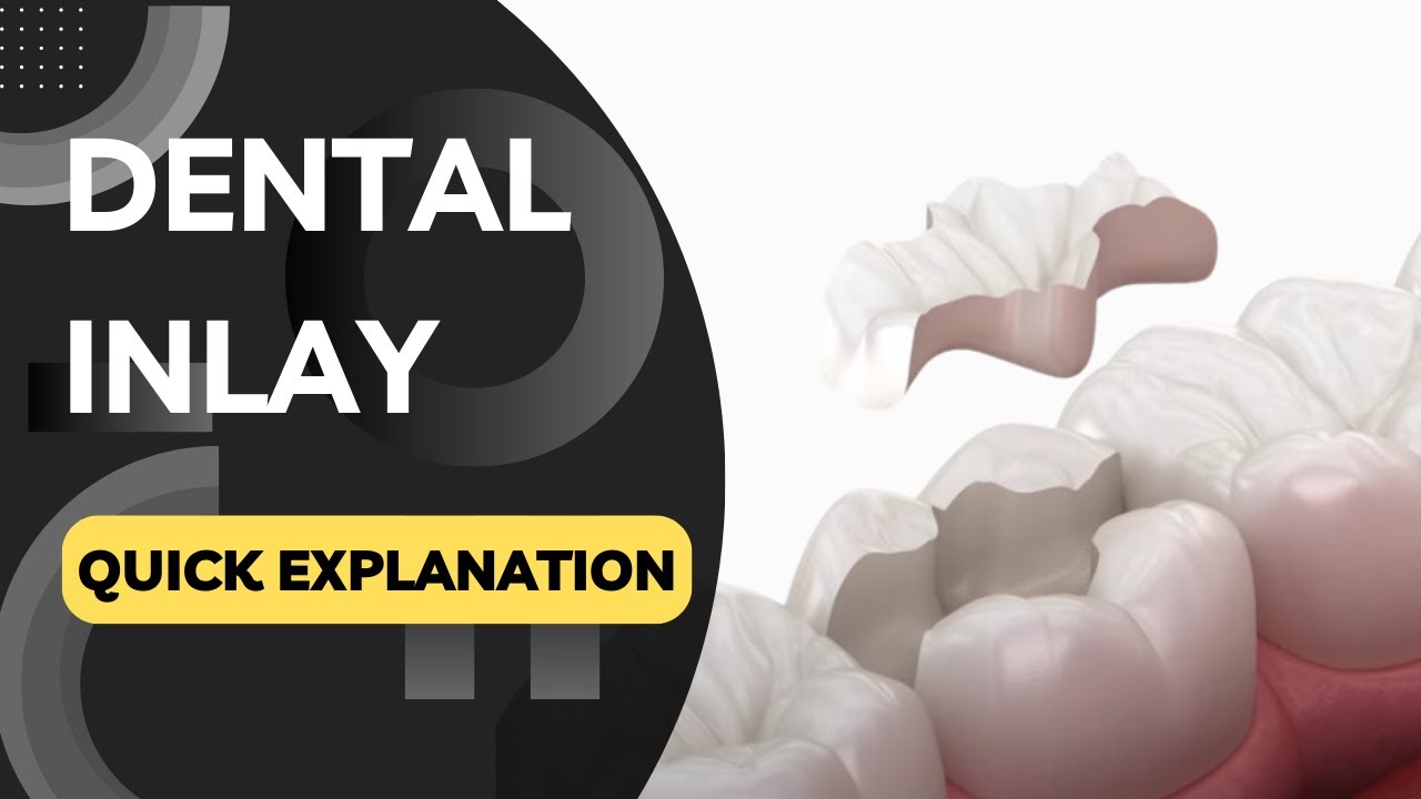 What is a Dental Inlay? Quickly Explained in a Few Seconds! - YouTube
