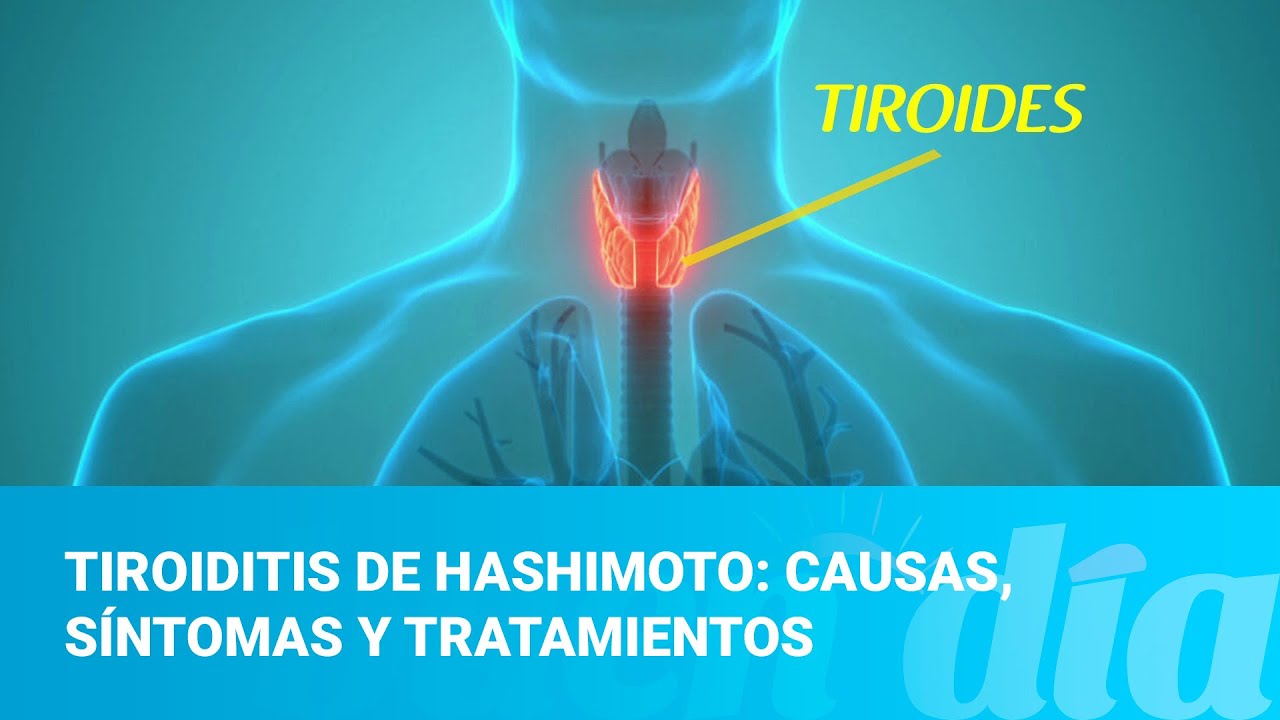 Tiroiditis de Hashimoto: causas, síntomas y tratamientos - YouTube