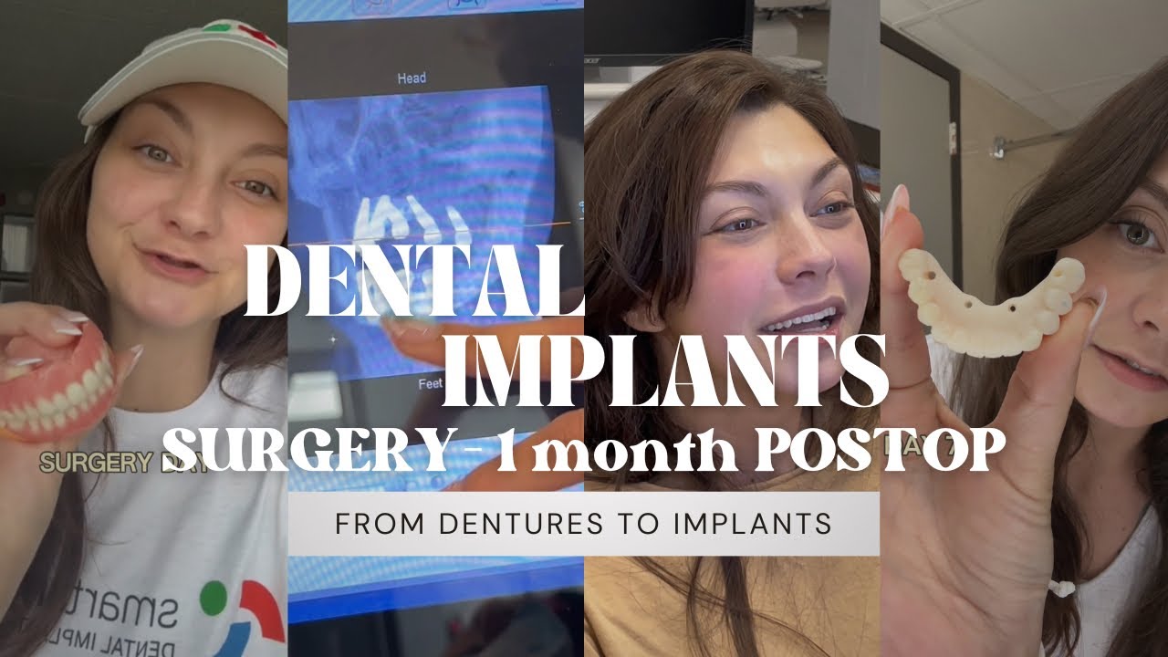 Dental Implants Journey - Surgery to 1 month POST OP - YouTube