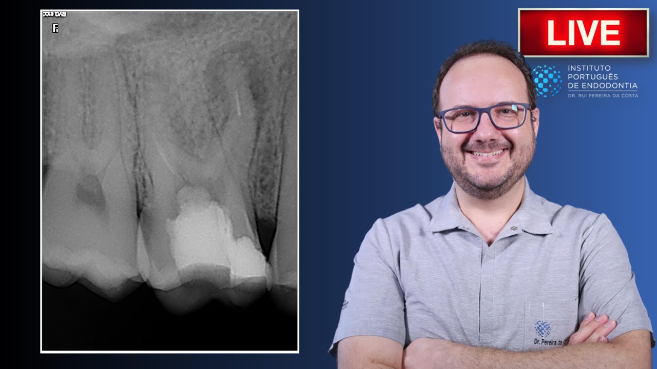 Rtx of 🦷16 with Separated File on MB canal ️ Part 2 | CASE207 - YouTube
