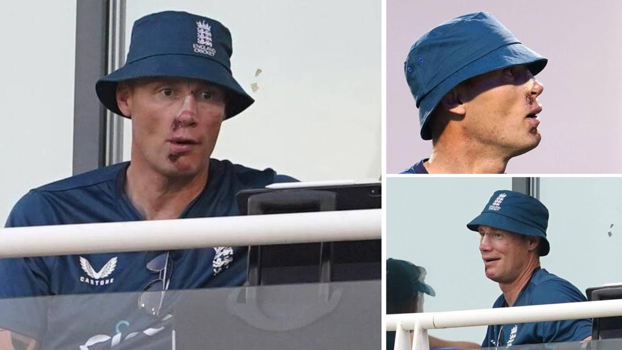 Flintoff still has facial injuries nine months after Top Gear crash ...