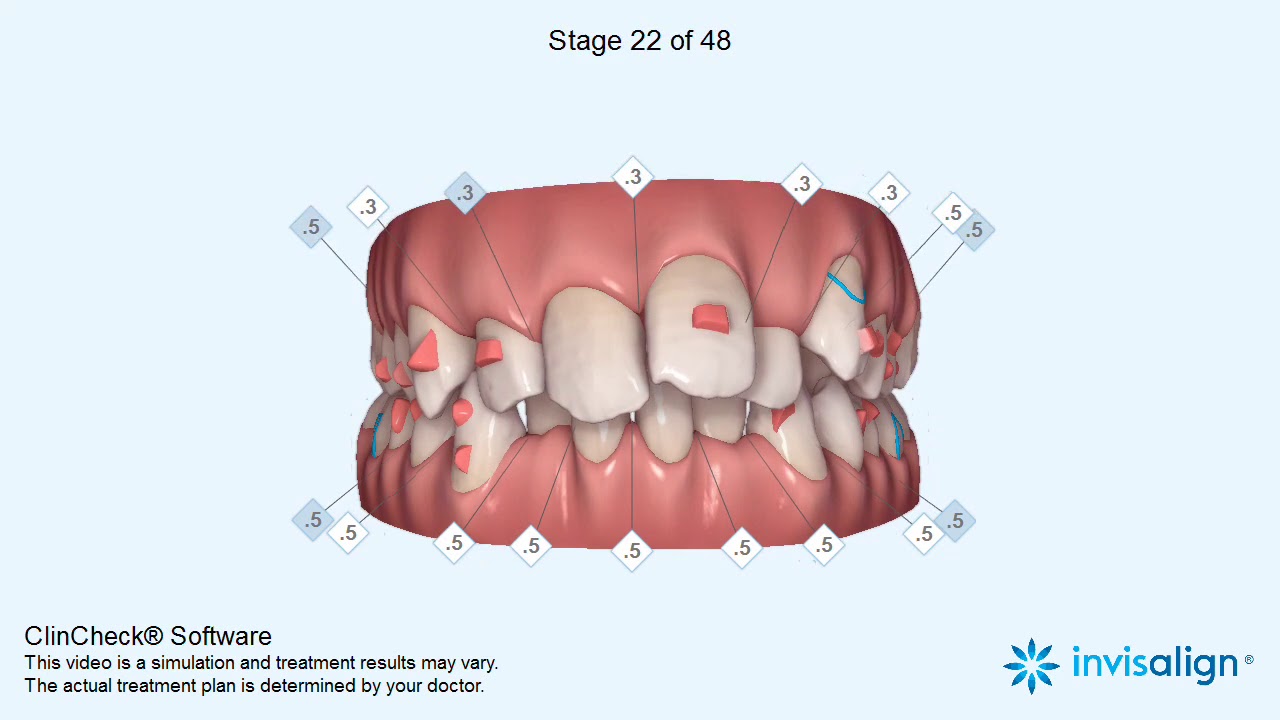 clincheck video anterior - YouTube