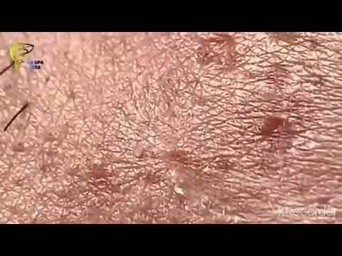 Rahatlatıcı Sivilce ve Siyah Nokta Sıkma Videoları (تهدئة البثور والرؤوس السوداء الفيديو.)😲😲😲 @ANSPA