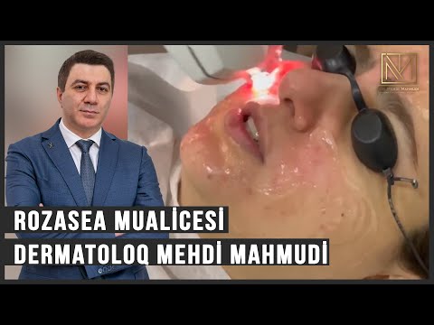 Rozasea mualicesi | Dermatoloq Mehdi Mahmudi