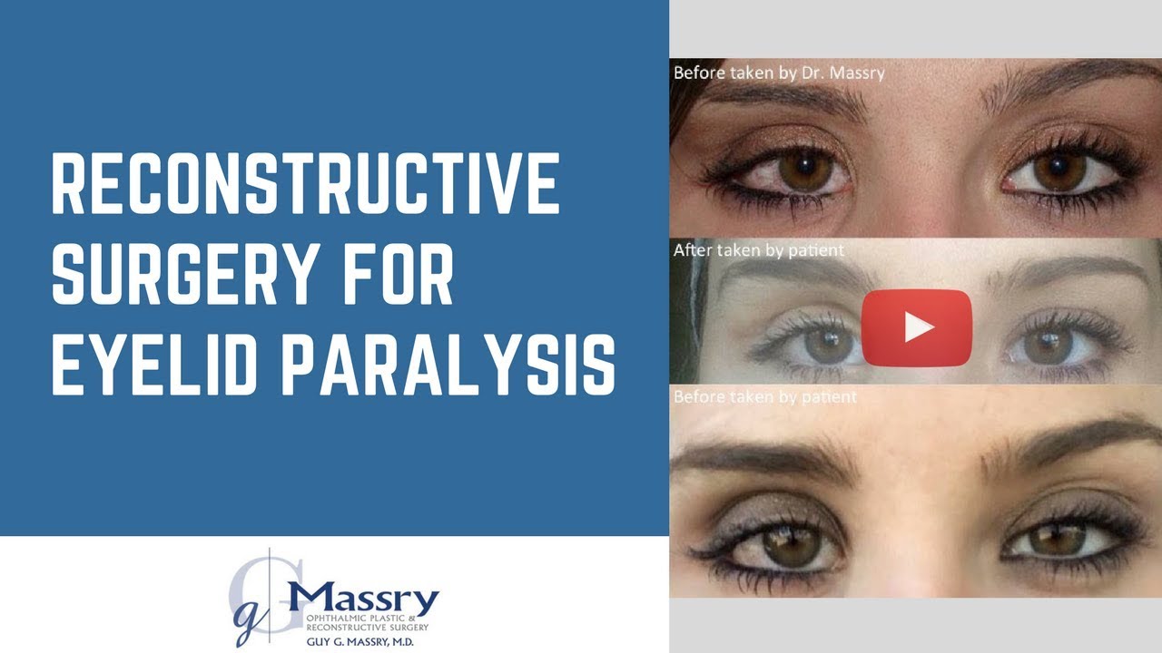 Happy Eyelid Paralysis Reconstruction Patient | Dr Guy Massry - YouTube
