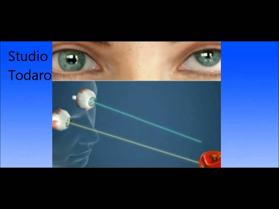 Lo Strabismo Diagnosi e Cure - YouTube