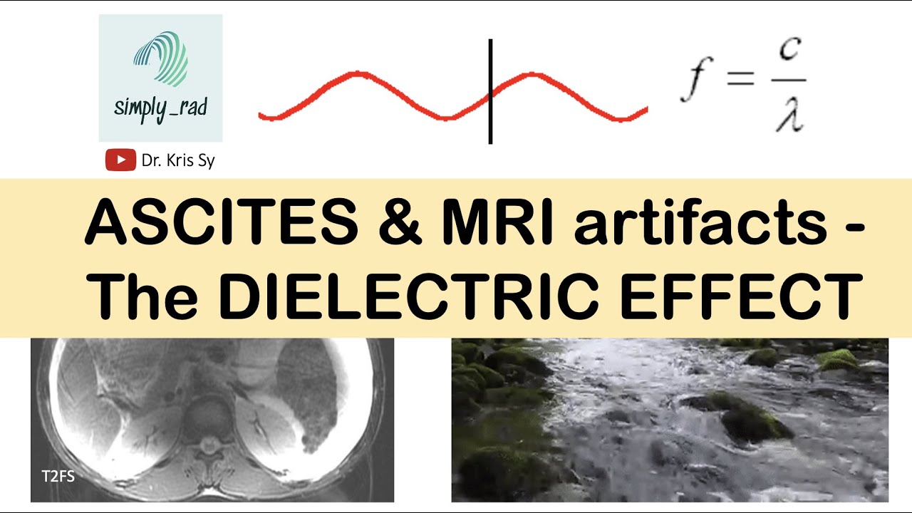 Ascites & abdomen MRI - the Dielectric Effect - YouTube