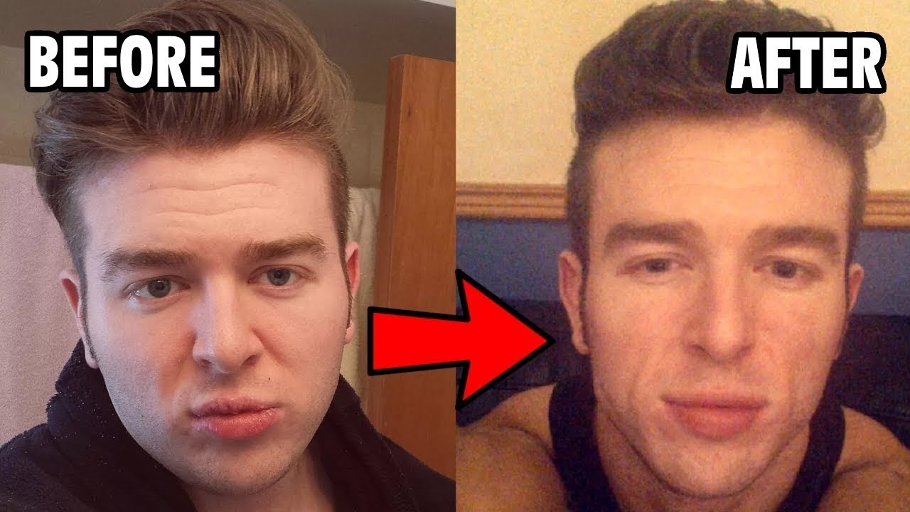 Amazing Mewing Before and After Photos - YouTube