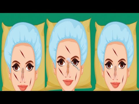 ASMR Agly face and nose Cleaning surgery treatment - YouTube