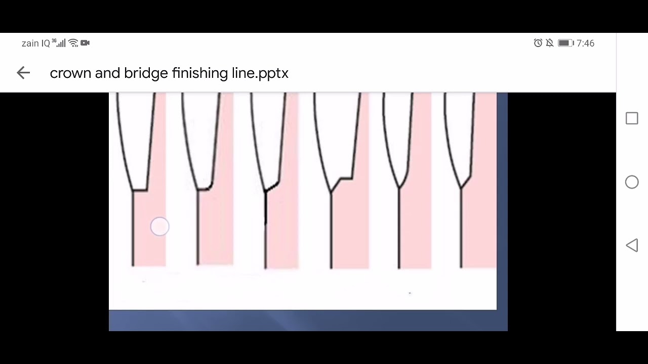 Finishing line of preperation crown and bridge - YouTube