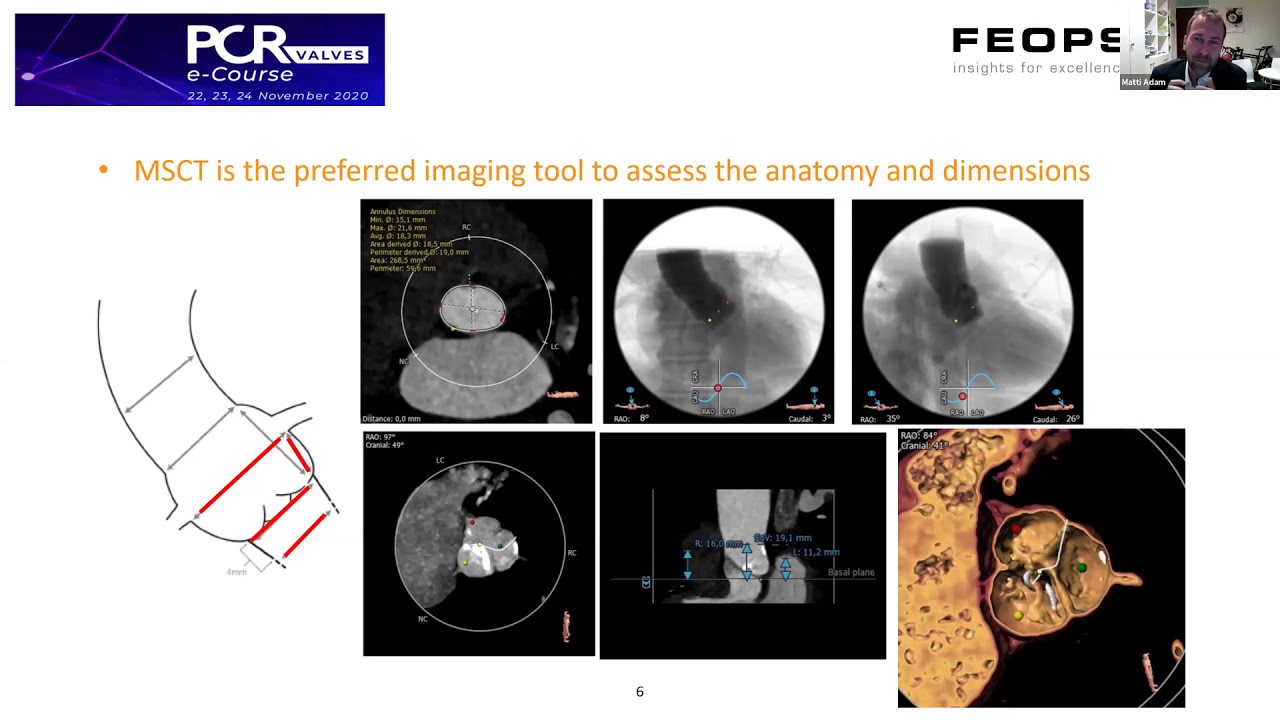 Complex TAVI interventions with Evolut™ with Dr. Matti Adam - YouTube