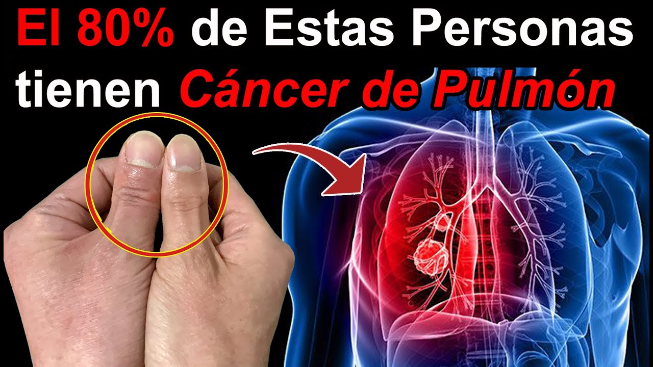 Revisa tus Dedos Ahora mismo! Esto es el Signo que tienes el Cáncer de ...
