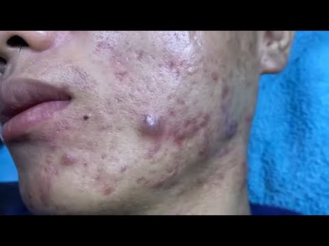 cystic acne blackhead whitehead removal | Relaxing Spa Acne Treatment ...