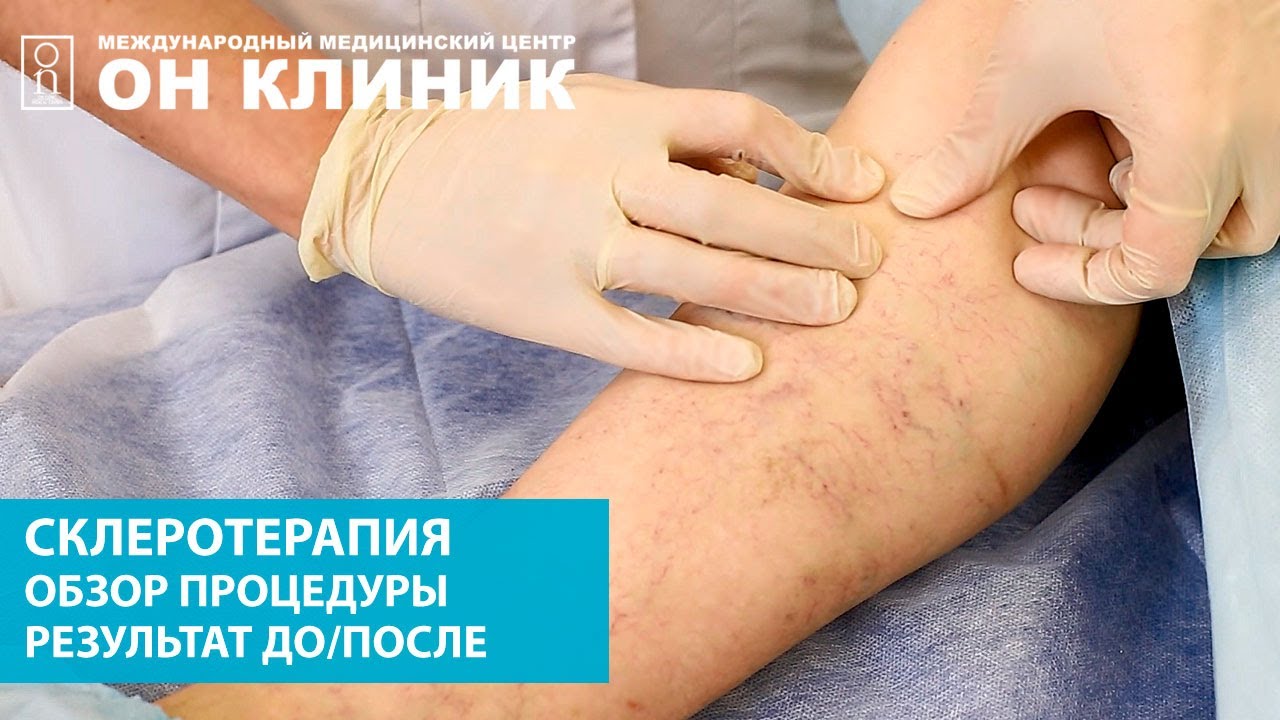 Лечение сосудистой сеточки на ногах. Склеротерапия. До/после - YouTube