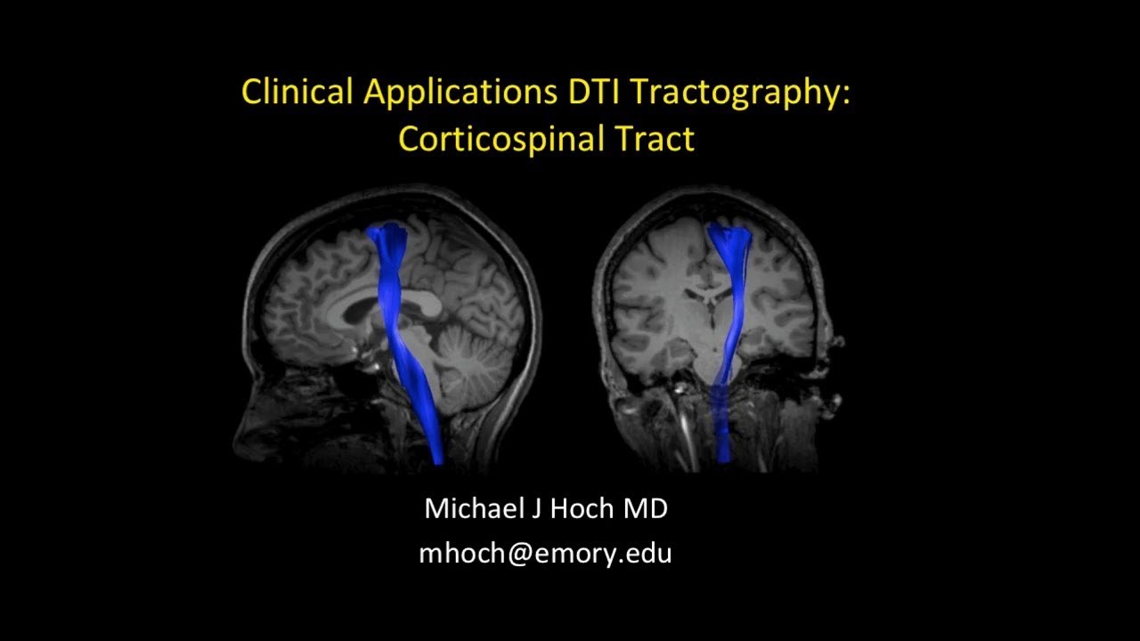 MRI Diffusion Tensor Imaging (DTI) interpretation - locating the ...