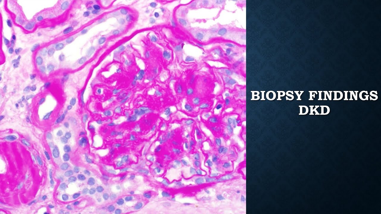 DIABETIC KIDNEY DISEASE (DKD) BIOPSY FINDINGS / DIABETIC NEPHROPATHY ...
