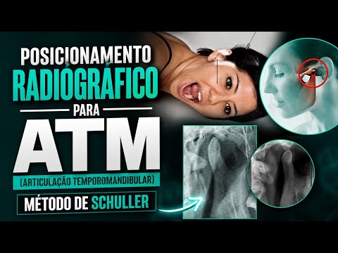 RAIO-X PARA ATM (ARTICULAÇÃO TEMPOROMANDIBULAR) MÉTODO DE SCHULLER ...