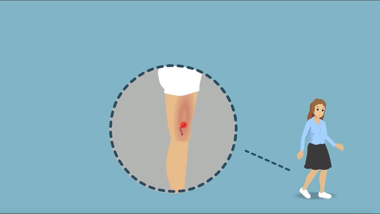 Laserbehandeling spatader (endovasculaire laser therapie) - YouTube