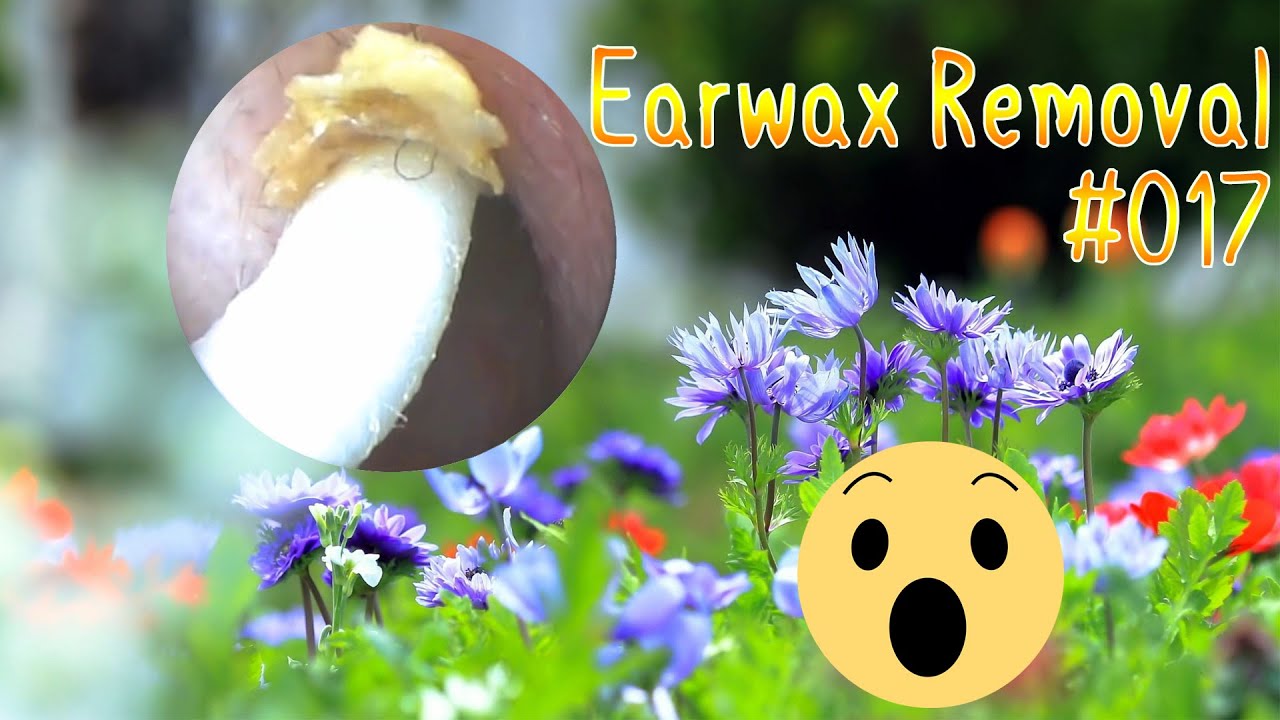 Ep #017 - 전방 및 하퇴 귀지 제거 - 귀지 제거 - YouTube