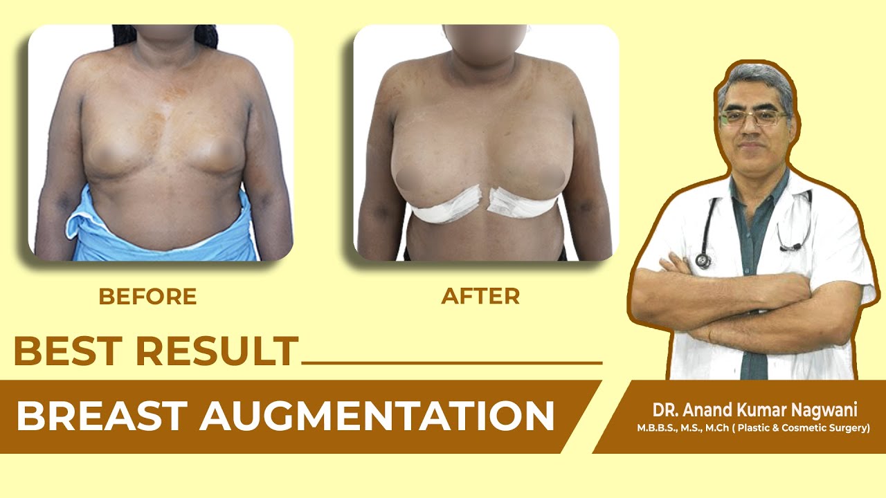 Breast Implant Before And After Result Silicon Breast Implant 30 Yrs breast-implant-before-and-after-result-silicon-breast-implant-30-yrs