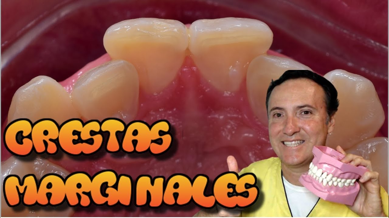 Crestas marginales y guía incisal - YouTube