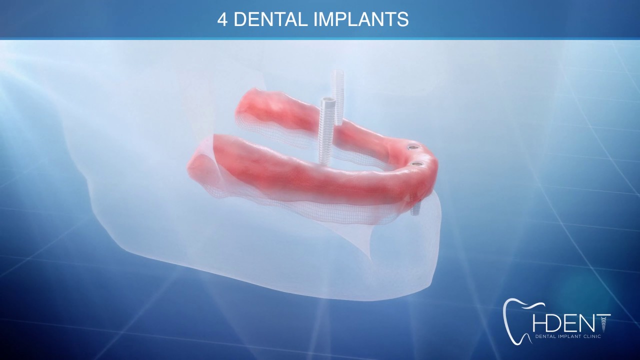 ALL on 4 dental implant procedure H-DENT - YouTube