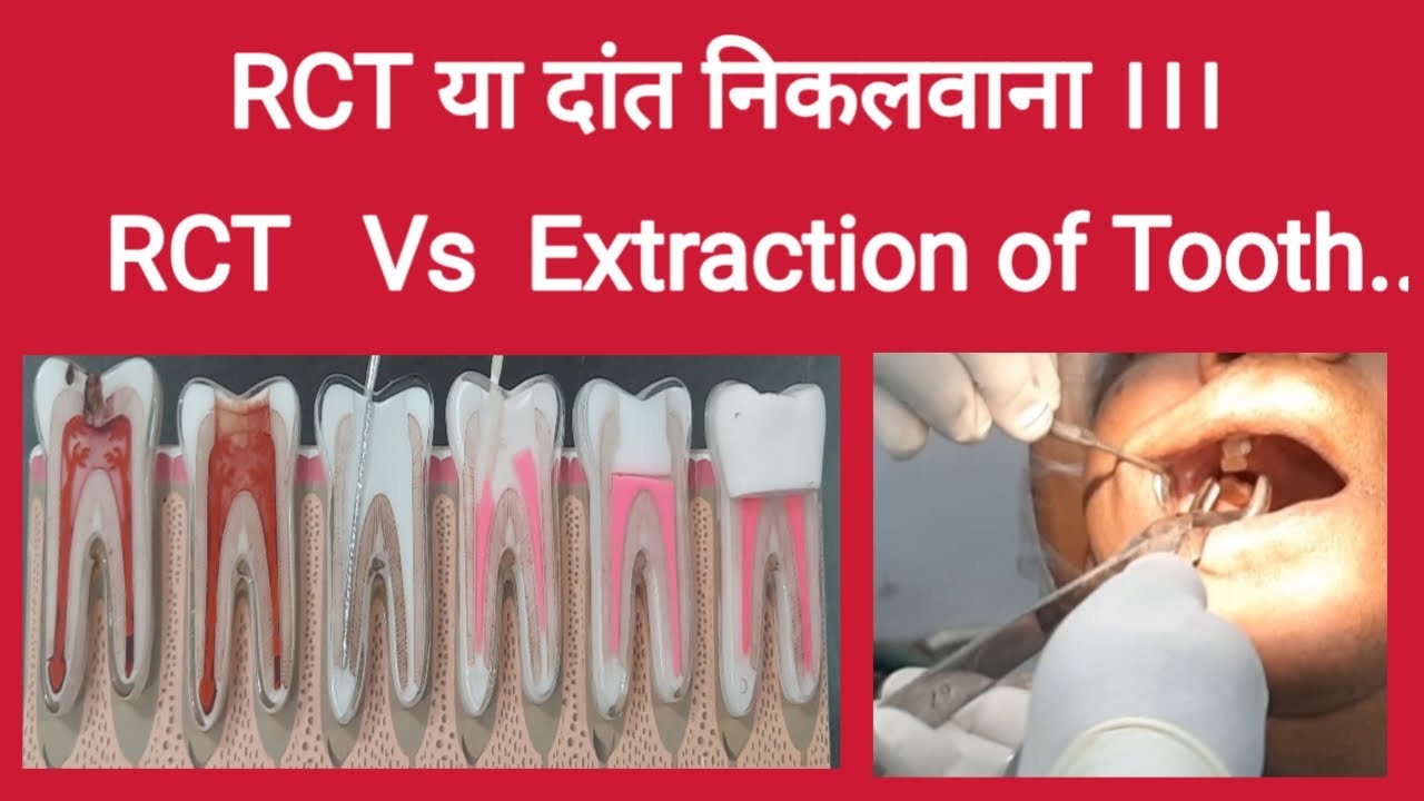 RCT या दांत निकलवाना। RCT Verses Extraction of Tooth ... - YouTube