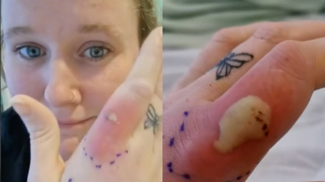 Lincolnshire woman in and out of hospital with spider bite - YouTube