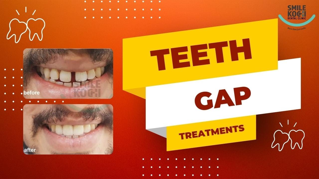 TEETH GAP | Smile Kochi Dental Clinic | Kadavanthara ...