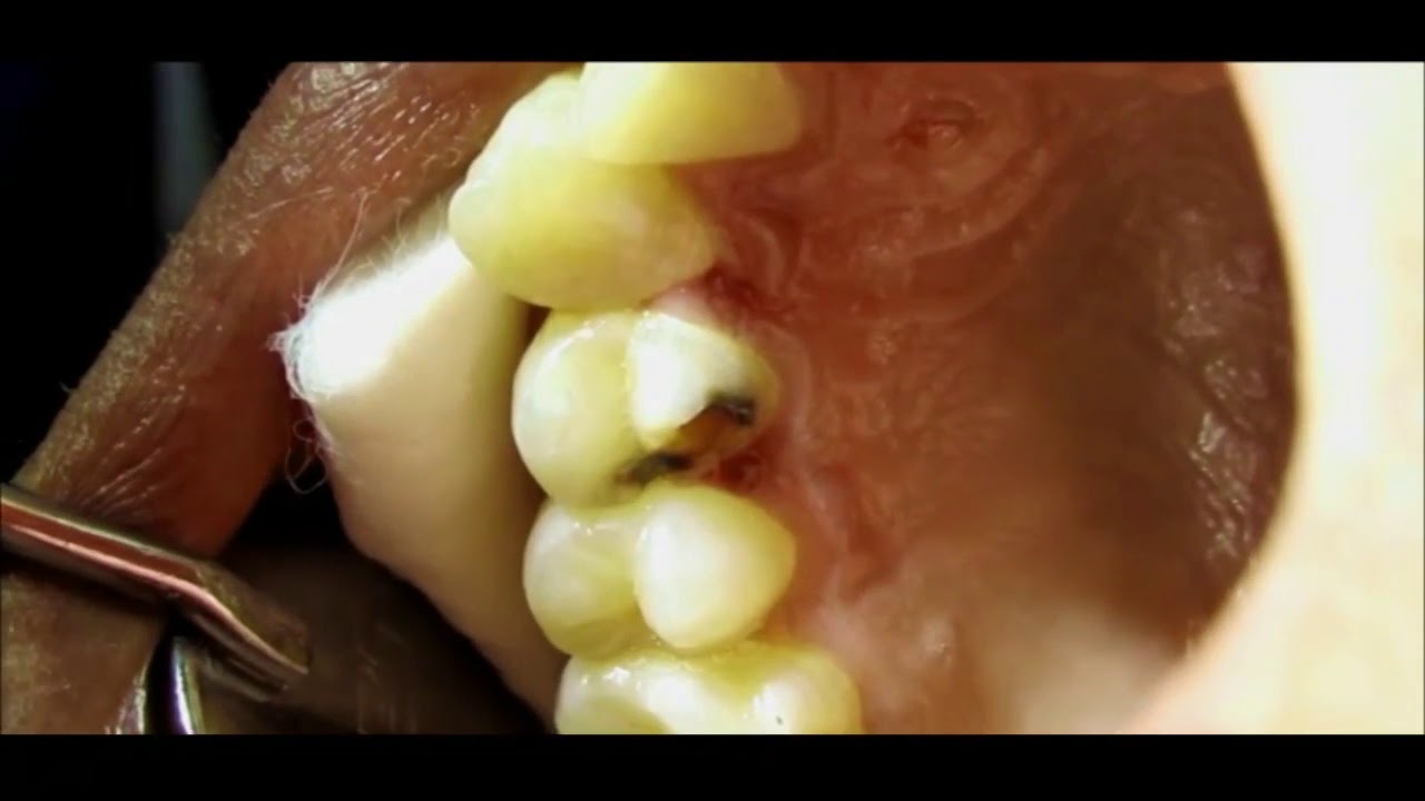 How To Use Carie Care Caries Solvent For Removing Dental Caries ...