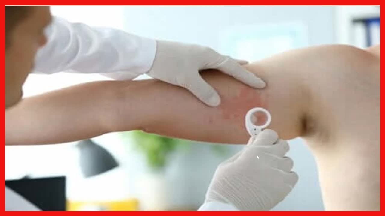 10 types et causes d'éruptions cutanées - YouTube