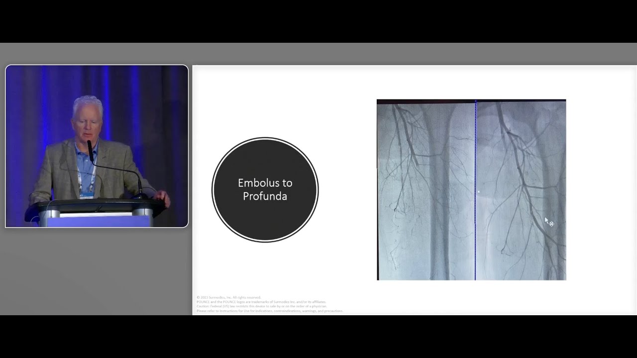 A Paradigm Shift in Arterial Thrombo-Embolectomy: Obtaining On-Table ...