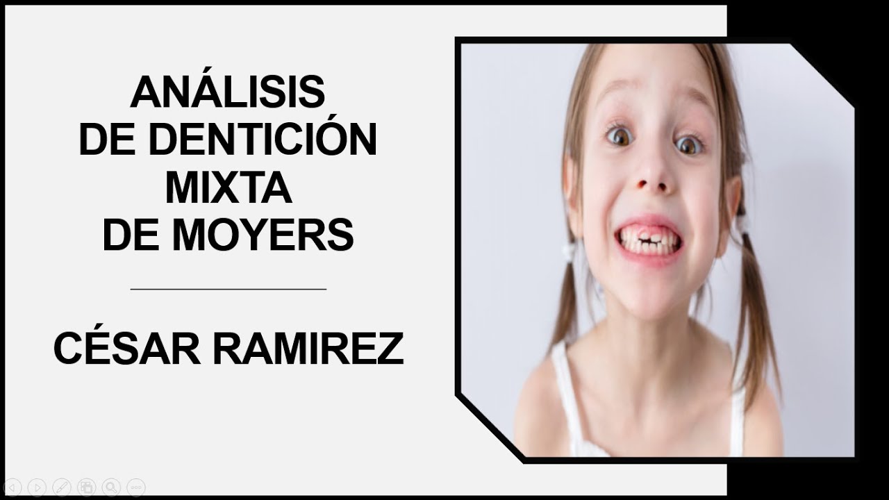 ANÁLISIS DE DENTICIÓN MIXTA DE MOYERS – 2022 - YouTube