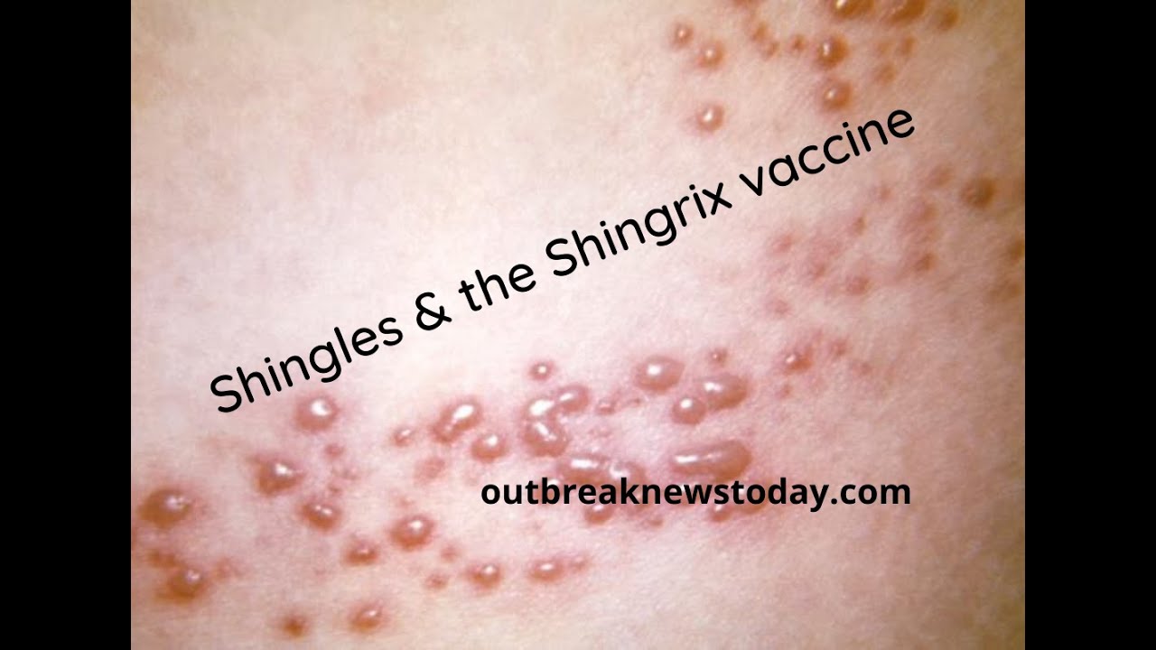 Shingles and the Shingrix vaccine - YouTube