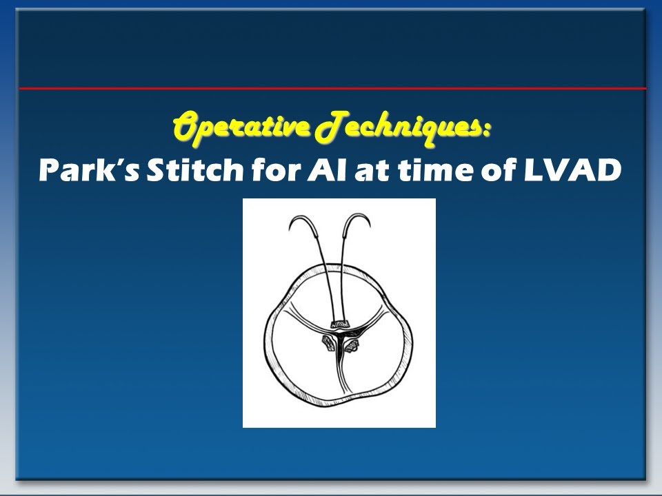 Central Coaptation (Park's) Stitch for Aortic Insufficency: Arie Blitz ...