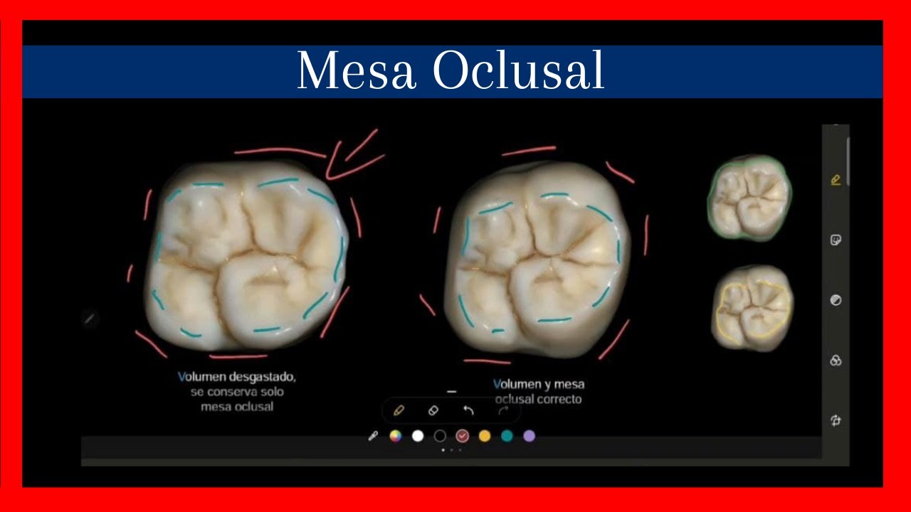 Morfología en digital primer molar superior [Mesa Oclusal] - YouTube