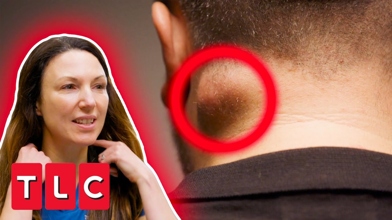 GIANT Neck Cyst Has Kept This Man From Dating | The Bad Skin Clinic ...