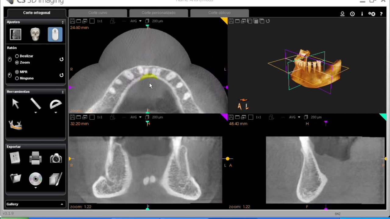 Tutorial CS 3D imaging software Carestream 03 Carestream Uso de la ...