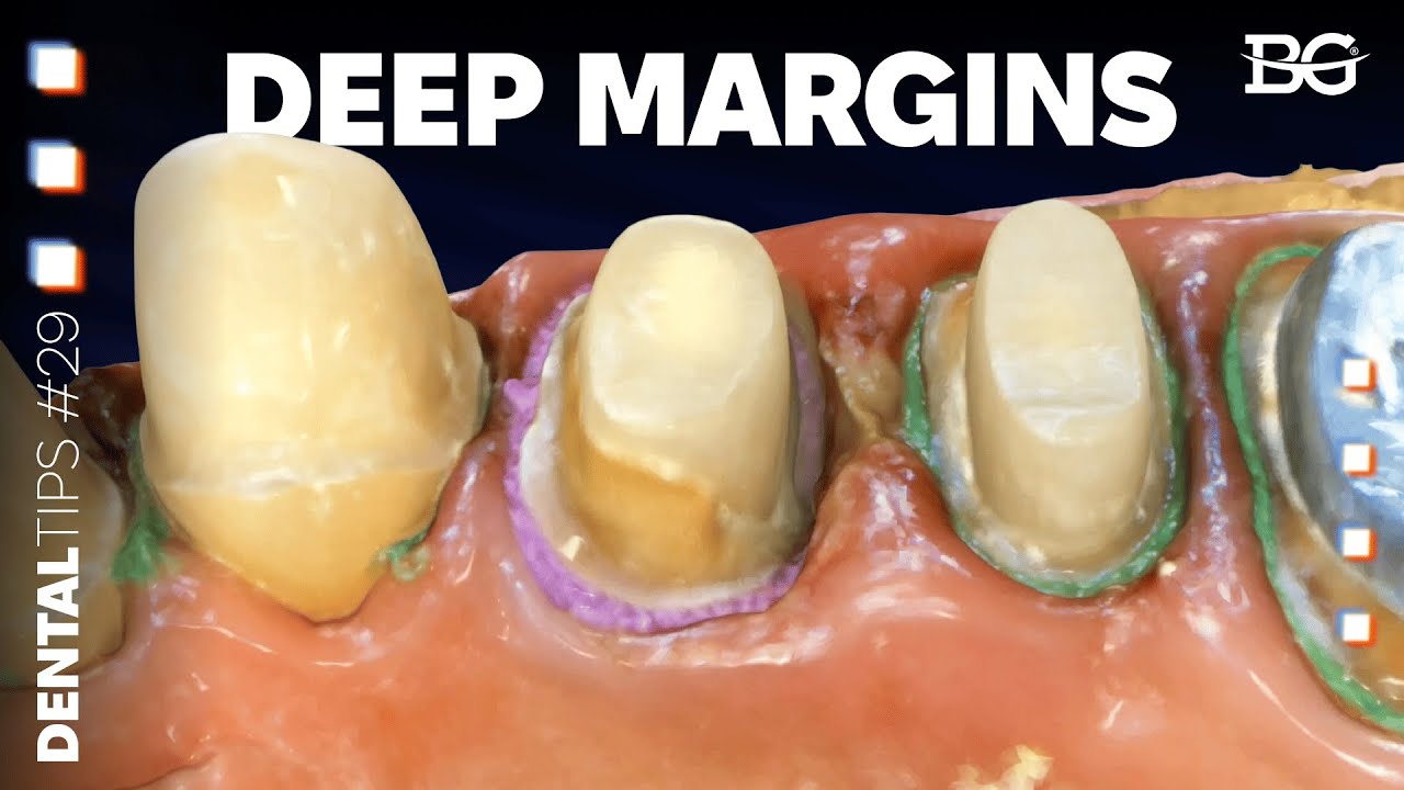 Managing extremely deep margins - YouTube