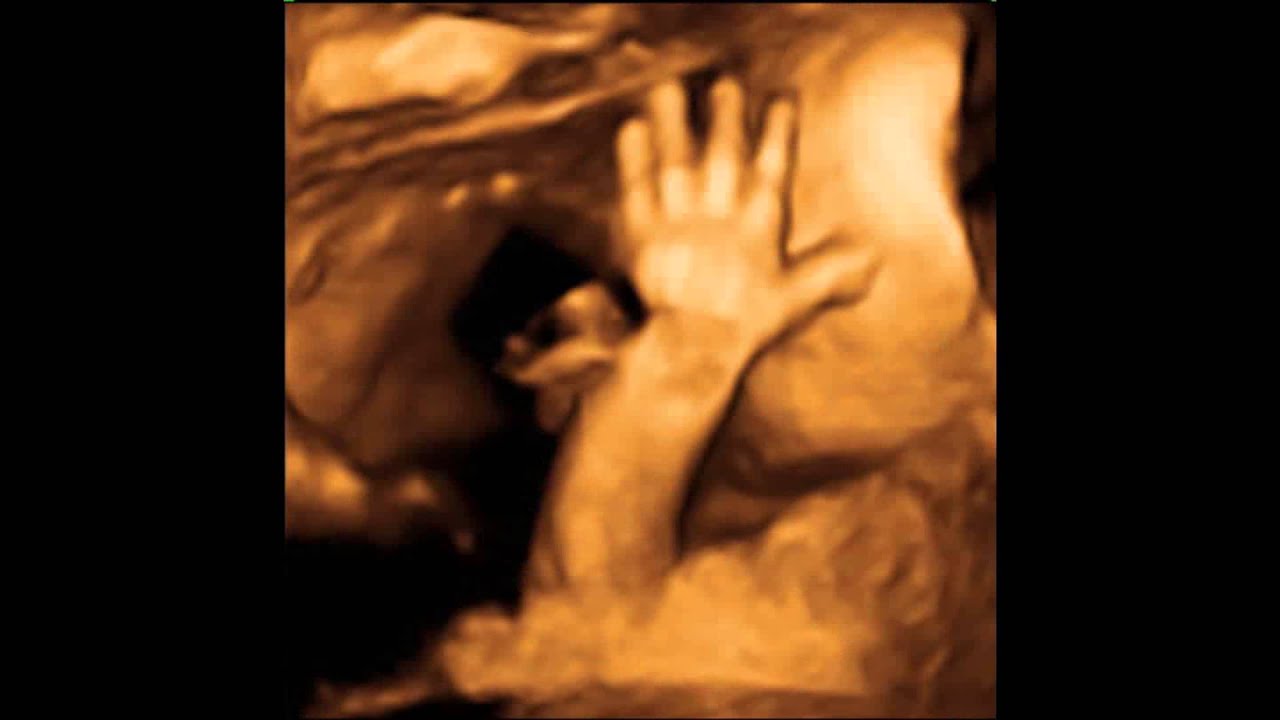MEDICINA FETAL ECOGRAFIAS EN 3D Y 4D - YouTube