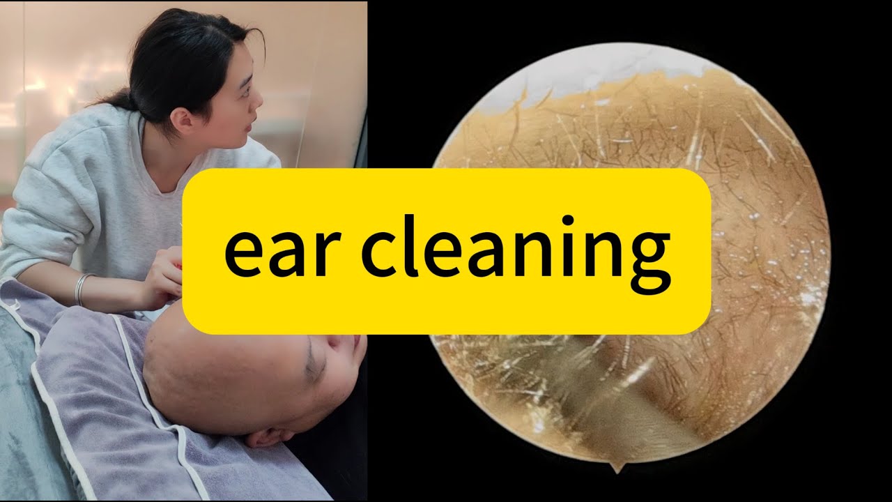 Earwax cleaning for a bald guy with oily ear canal #asmr #earcleaning# ...