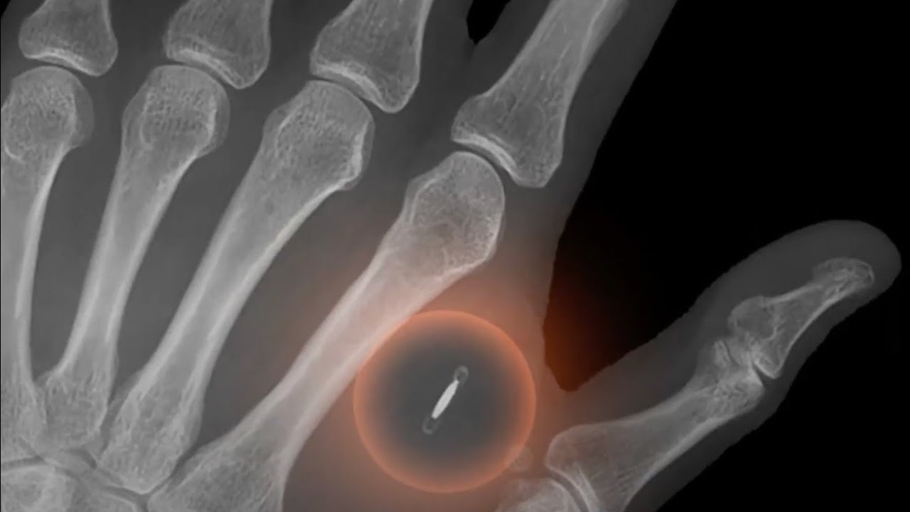 🚫bank chip implanted in hand MOTB - YouTube
