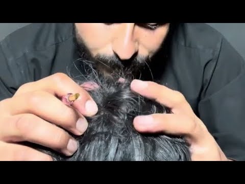 ASMR HAIR VIDEO SLAPS COLLEGE SONDA ASMR INGROWN HAIRS SATISFYING - YouTube