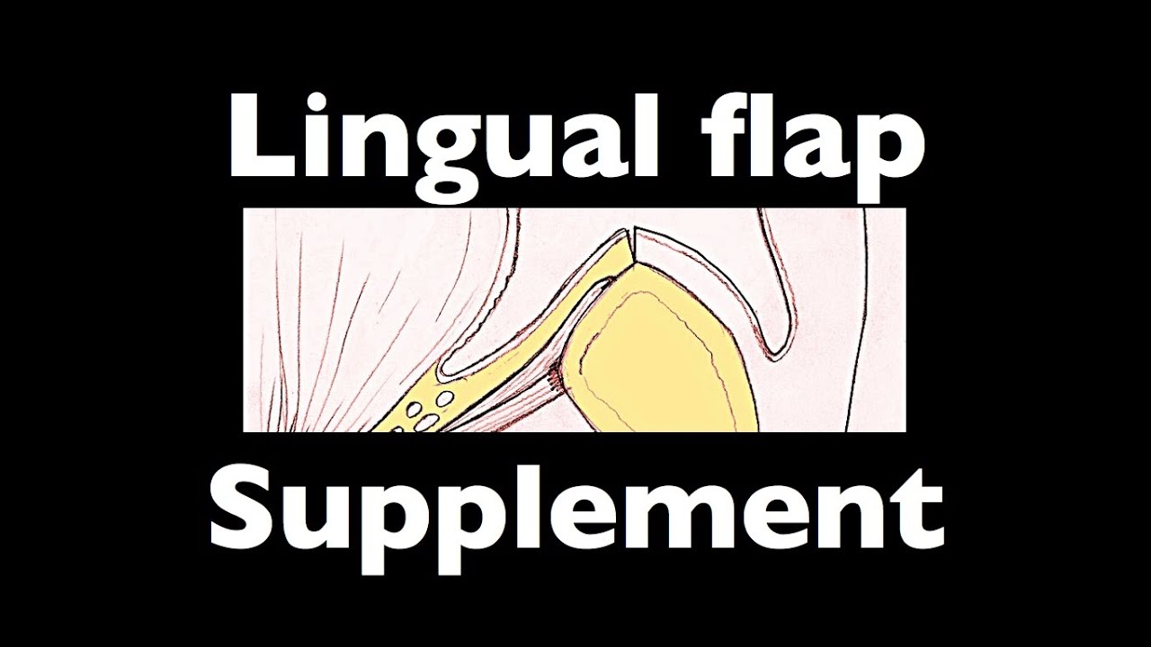 Lingual Flap Supplement - Dr. Paolo Rossetti - Milano - YouTube